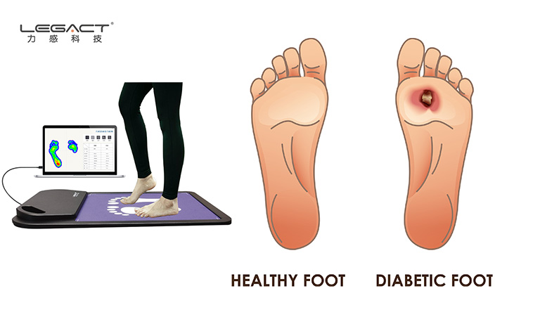 Application of Thin-Film Pressure Sensors in Diabetic Foot Disease ...